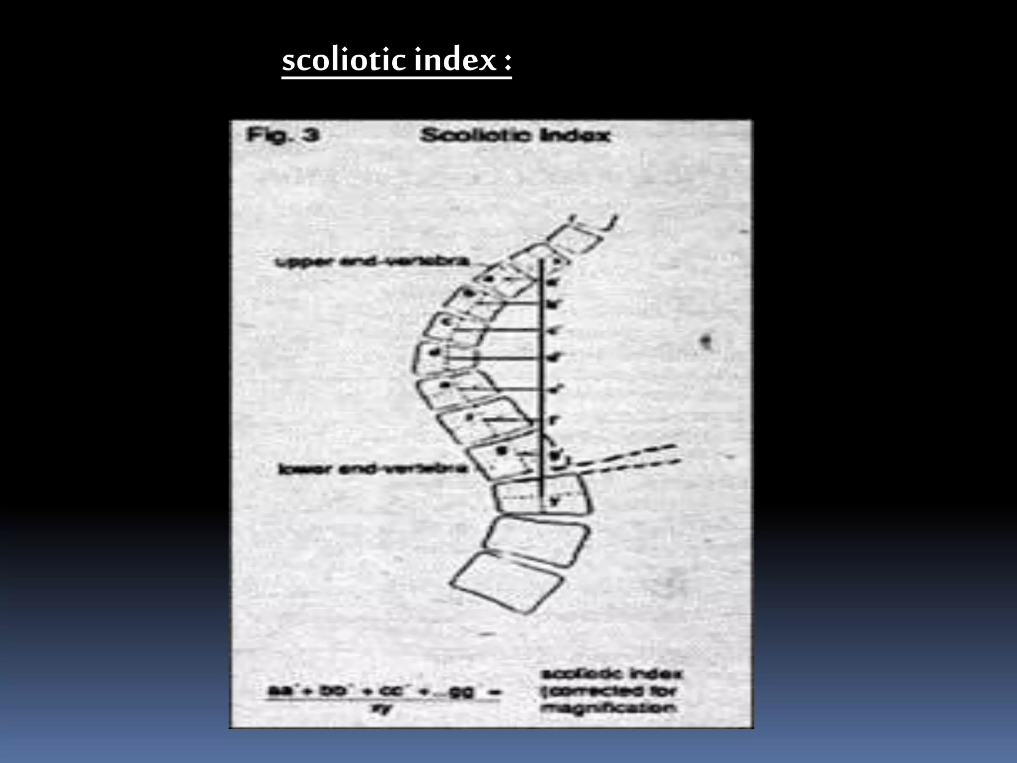 Scoliosis | PPTX