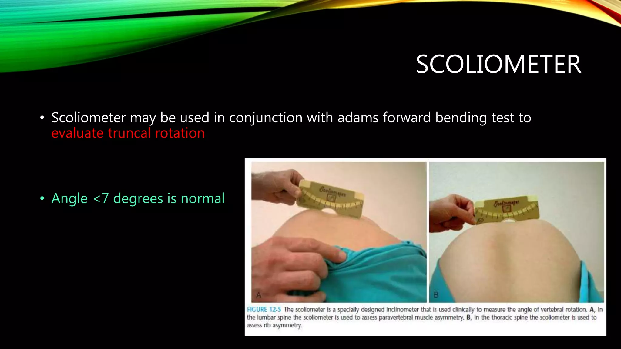 Scoliosis | PPTX
