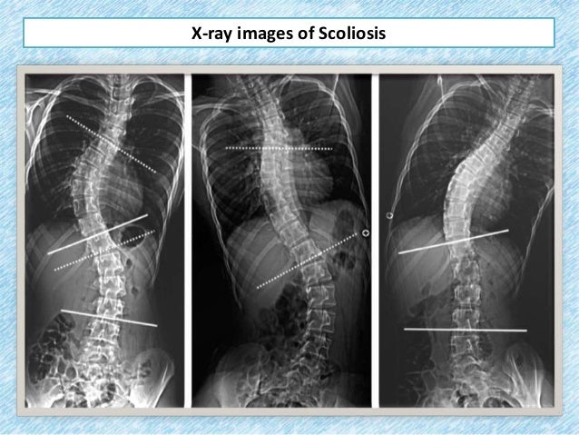 Scoliosis