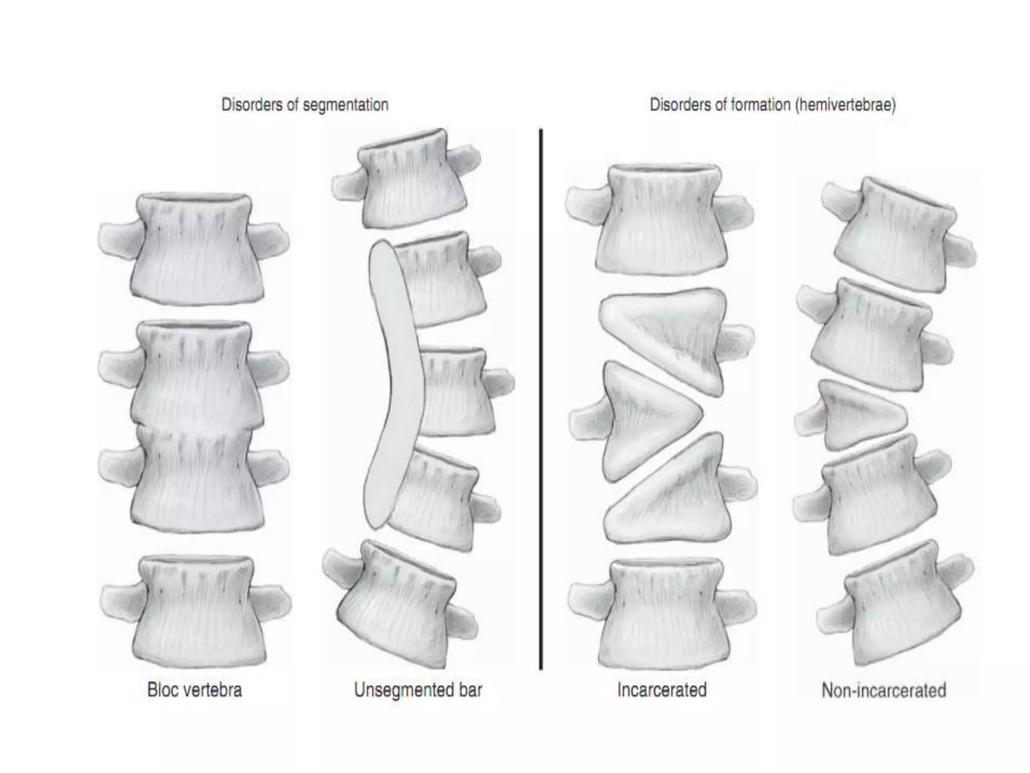 Scoliosis basics, classification | PPTX