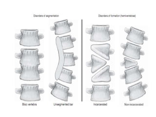 Scoliosis basics, classification | PPTX