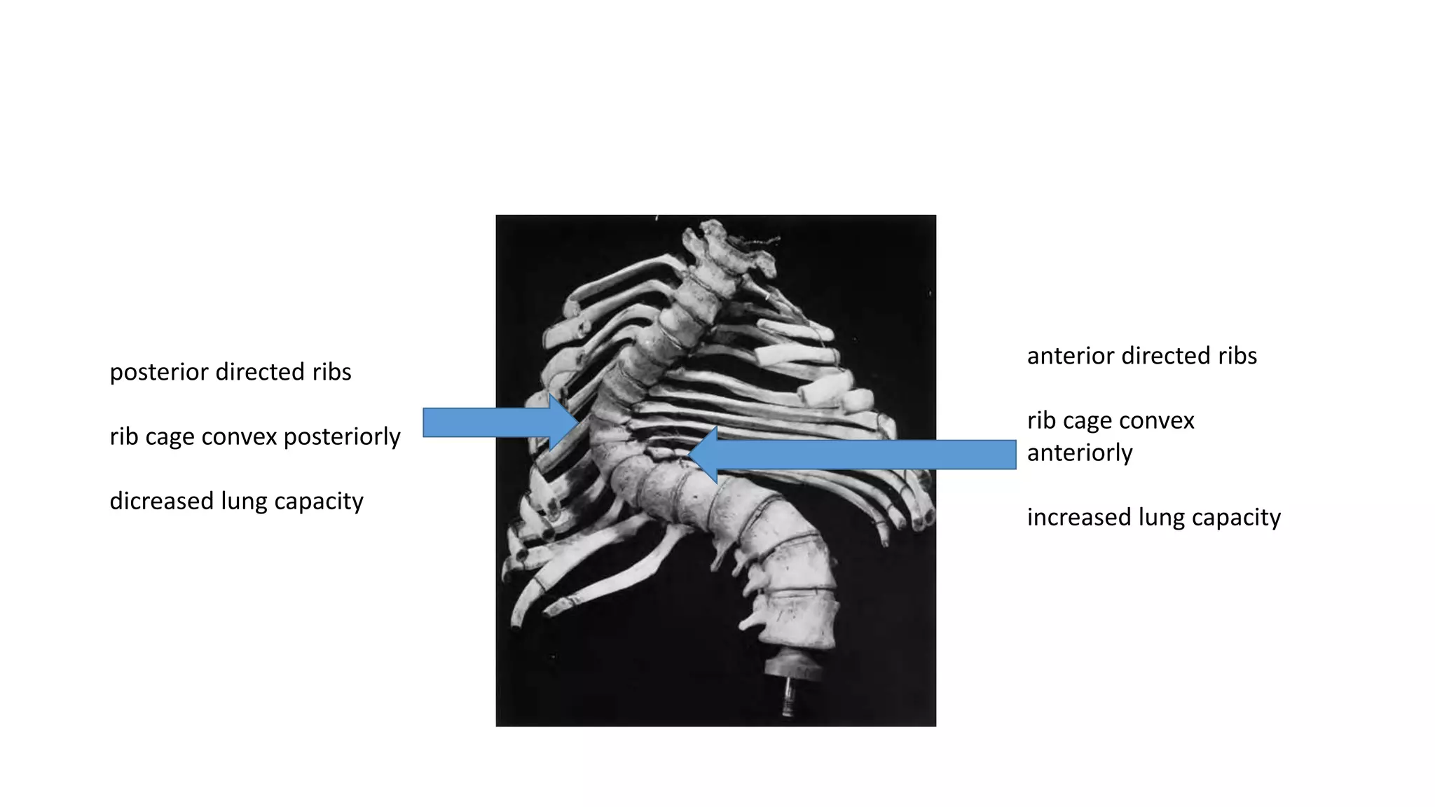 Scoliosis | PPTX