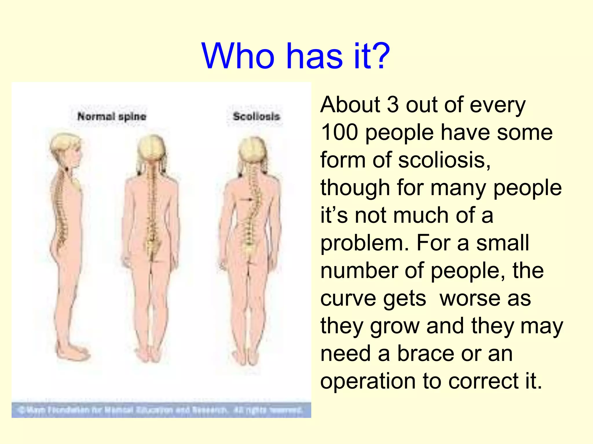 Scoliosis | PPTX