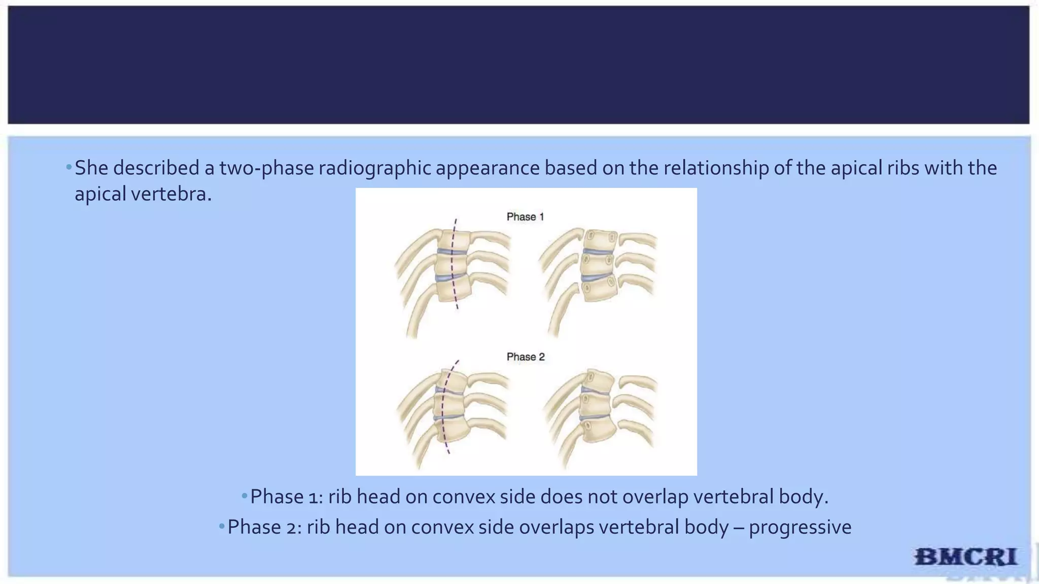 Scoliosis | PPTX