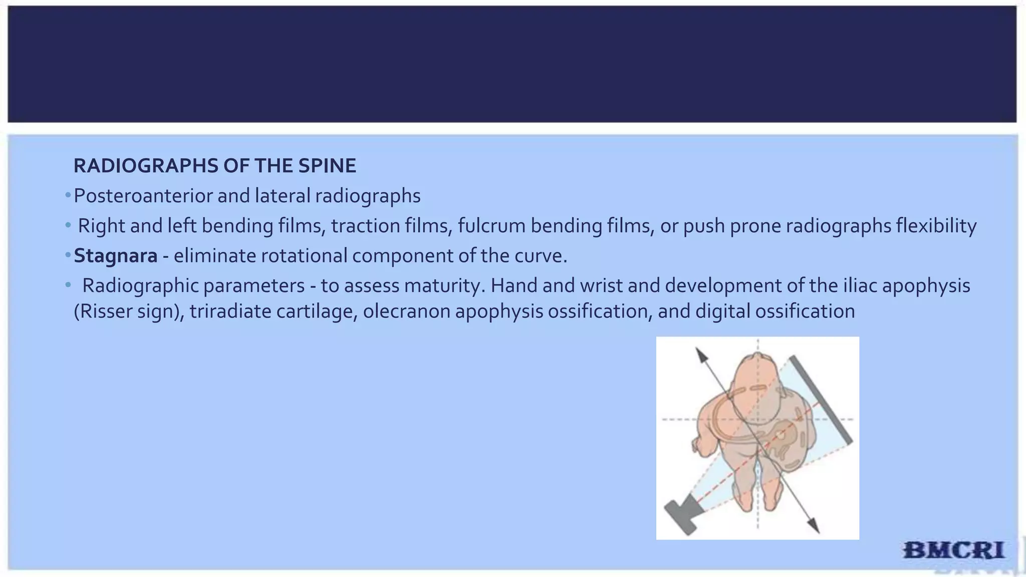 Scoliosis | PPTX