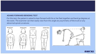 Scoliosis | PPTX