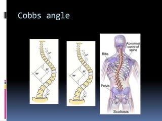Physiotherapy management of scoliosis.A physiotherapist prospective | PPTX