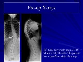 Case Review #14: 16 year old female with progressive adolescent ...