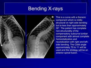 Case Review #G: 15 year old male with Adolescent Scoliosis | PPT
