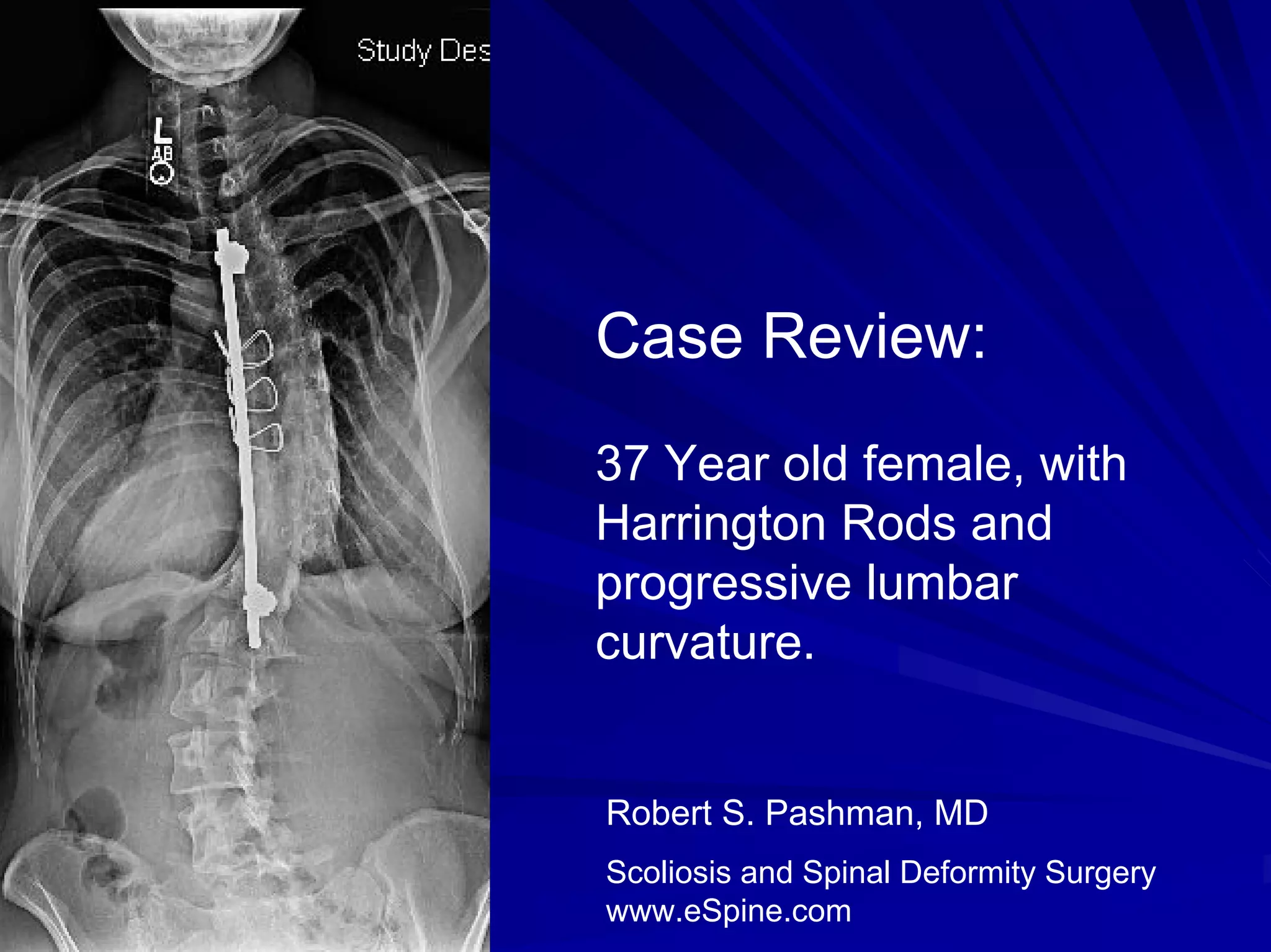 Case Review #28: Patient with Lumbar Scoliosis status post surgery with ...