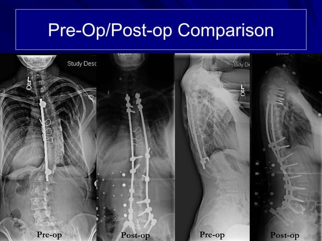 Case Review #28: Patient with Lumbar Scoliosis status post surgery with ...