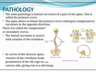 SCOLIOSIS Presentation, assessment, types and Treatment, Management | PPTX