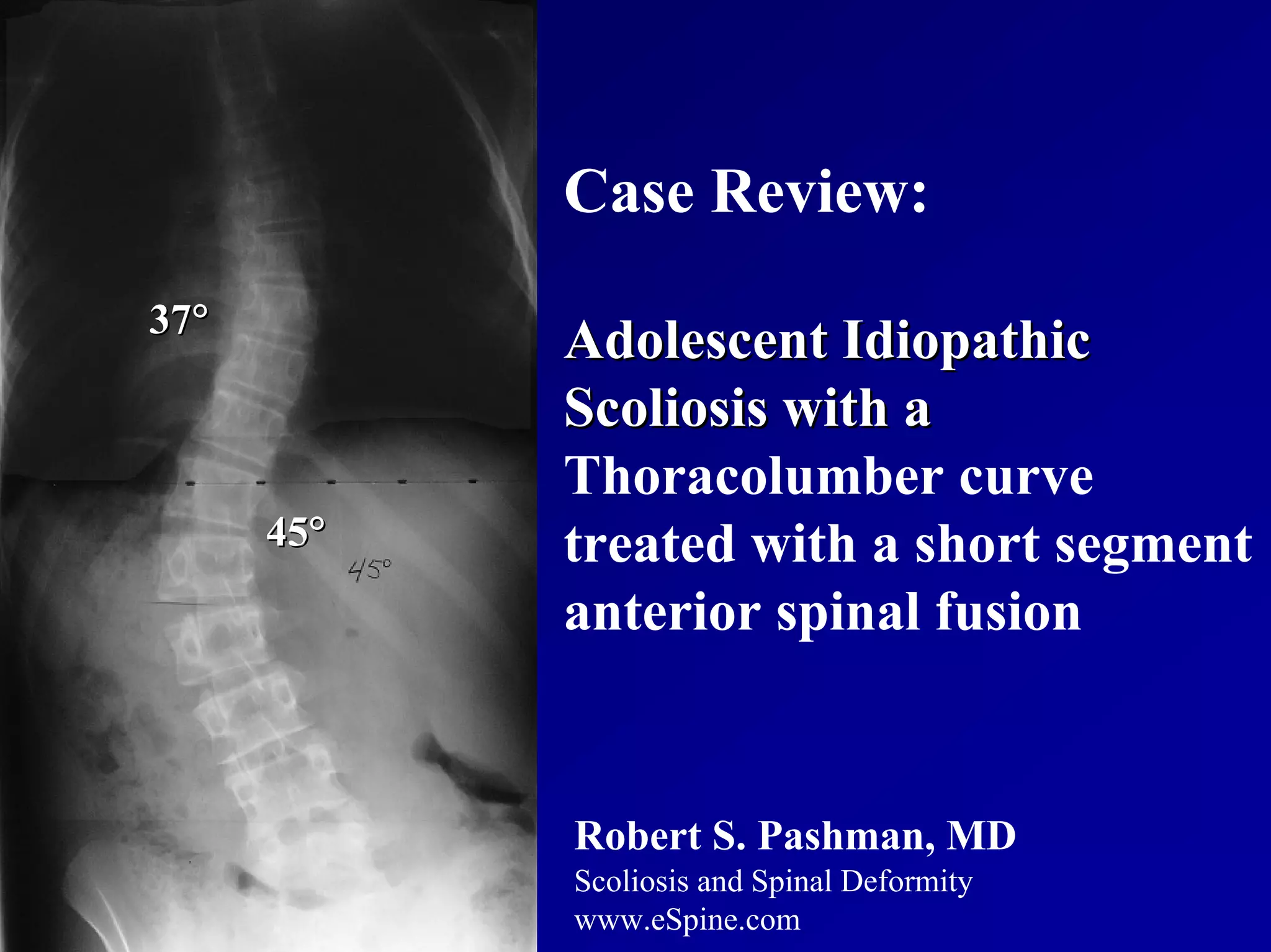 Case Review #C: Adolescent Idiopathic Scoliosis | PPT