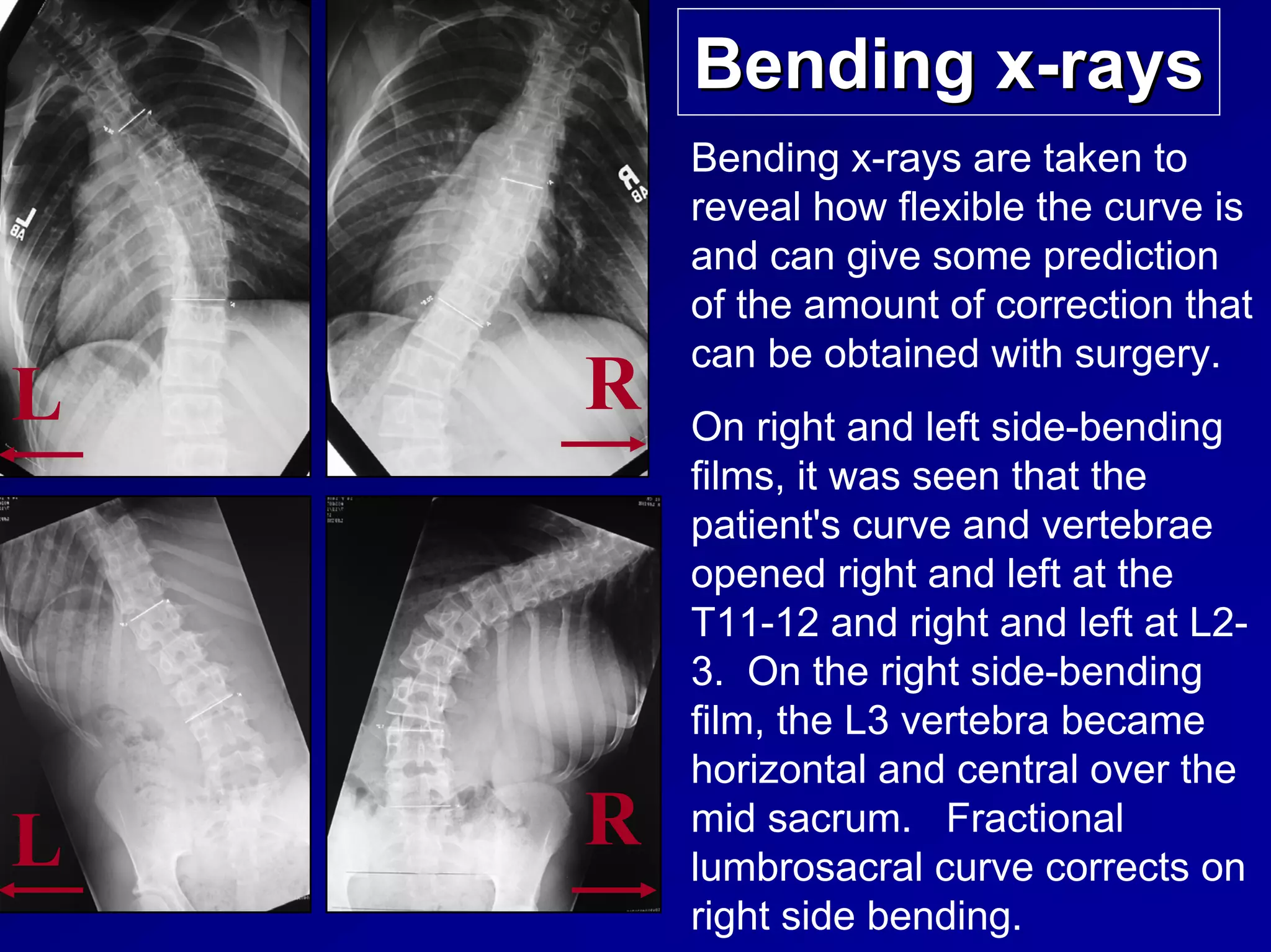 Case Review #C: Adolescent Idiopathic Scoliosis | PPT