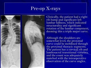 Case Review #21: Triple Curvature Adult Idiopathic Scoliosis | PDF