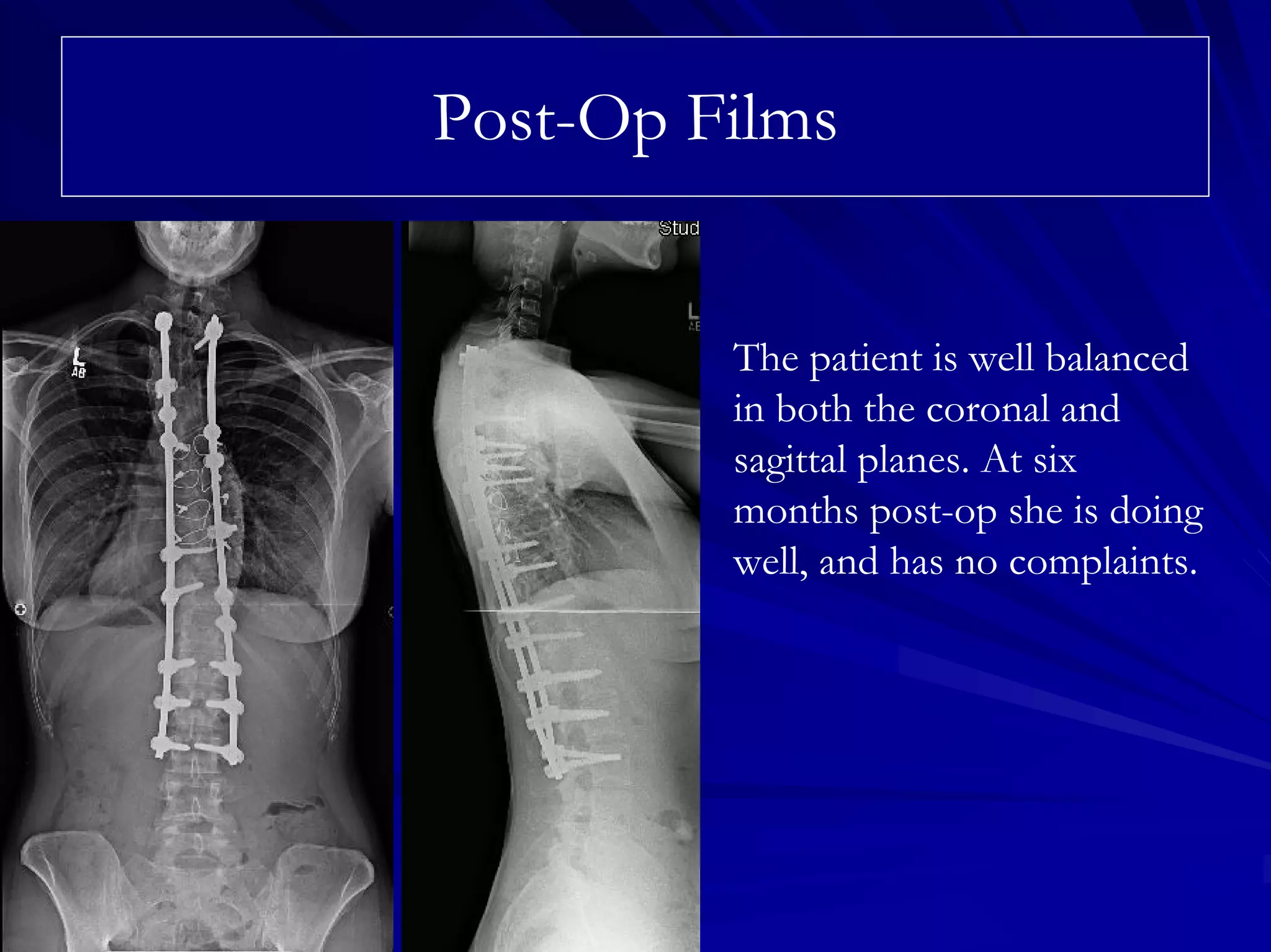 Case Review #38: 22 year old female status post spinal fusion with ...