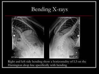 Case Review #20: 15 year old female with Adolescent Idiopathic ...