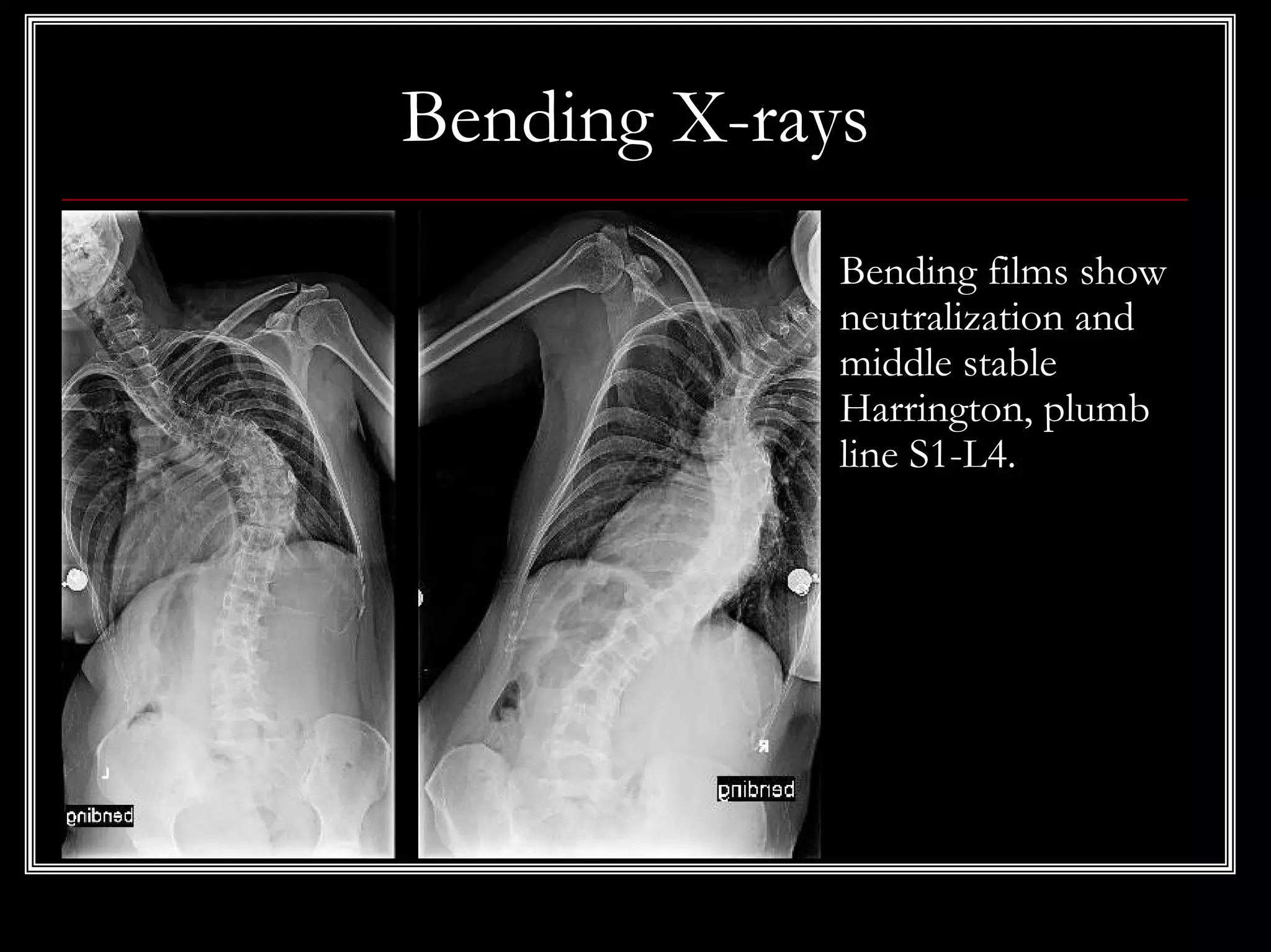 Case Review #41: 35 year old female with a 92 degree Scoliosis | PDF