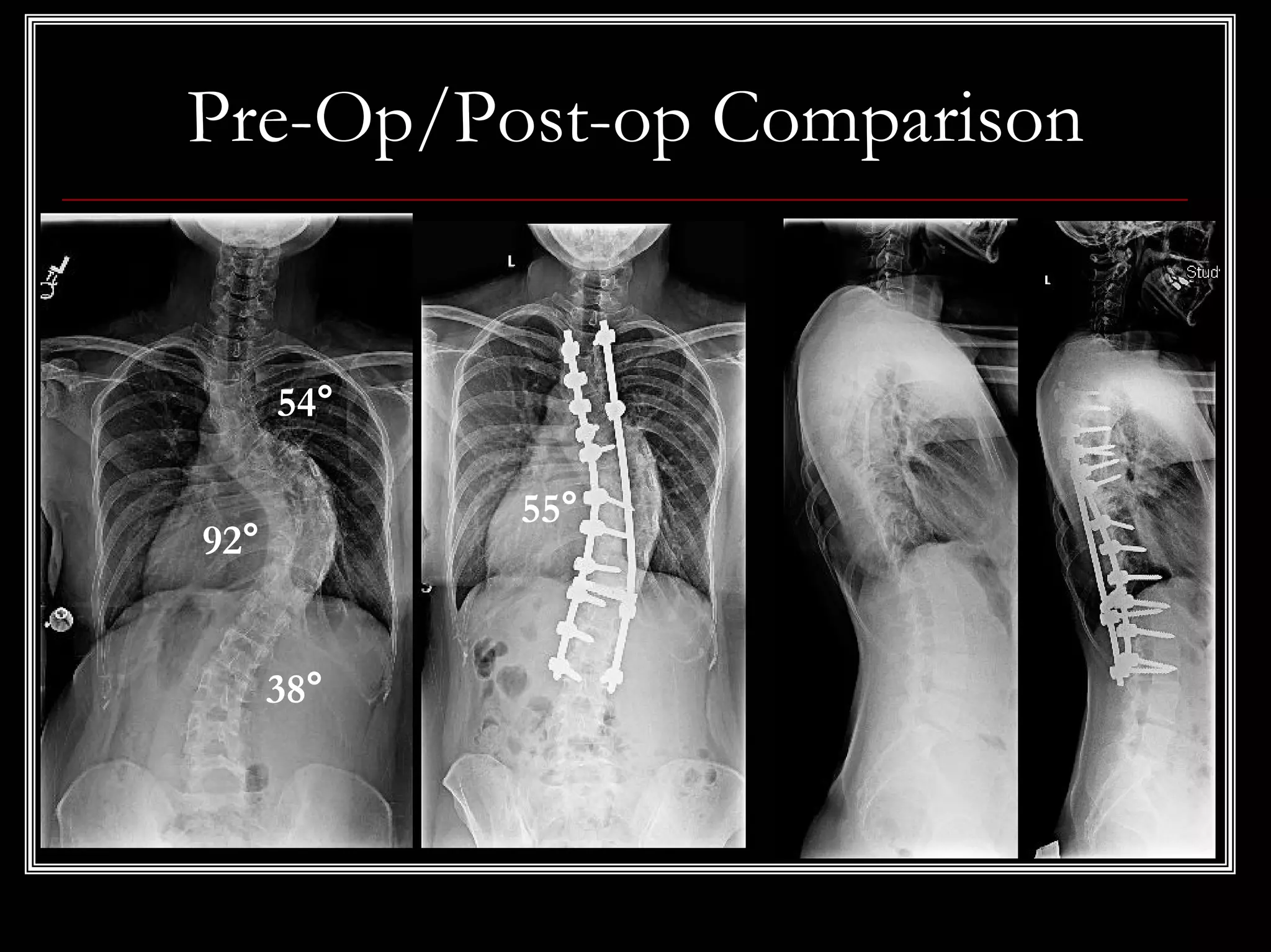 Case Review #41: 35 year old female with a 92 degree Scoliosis | PDF