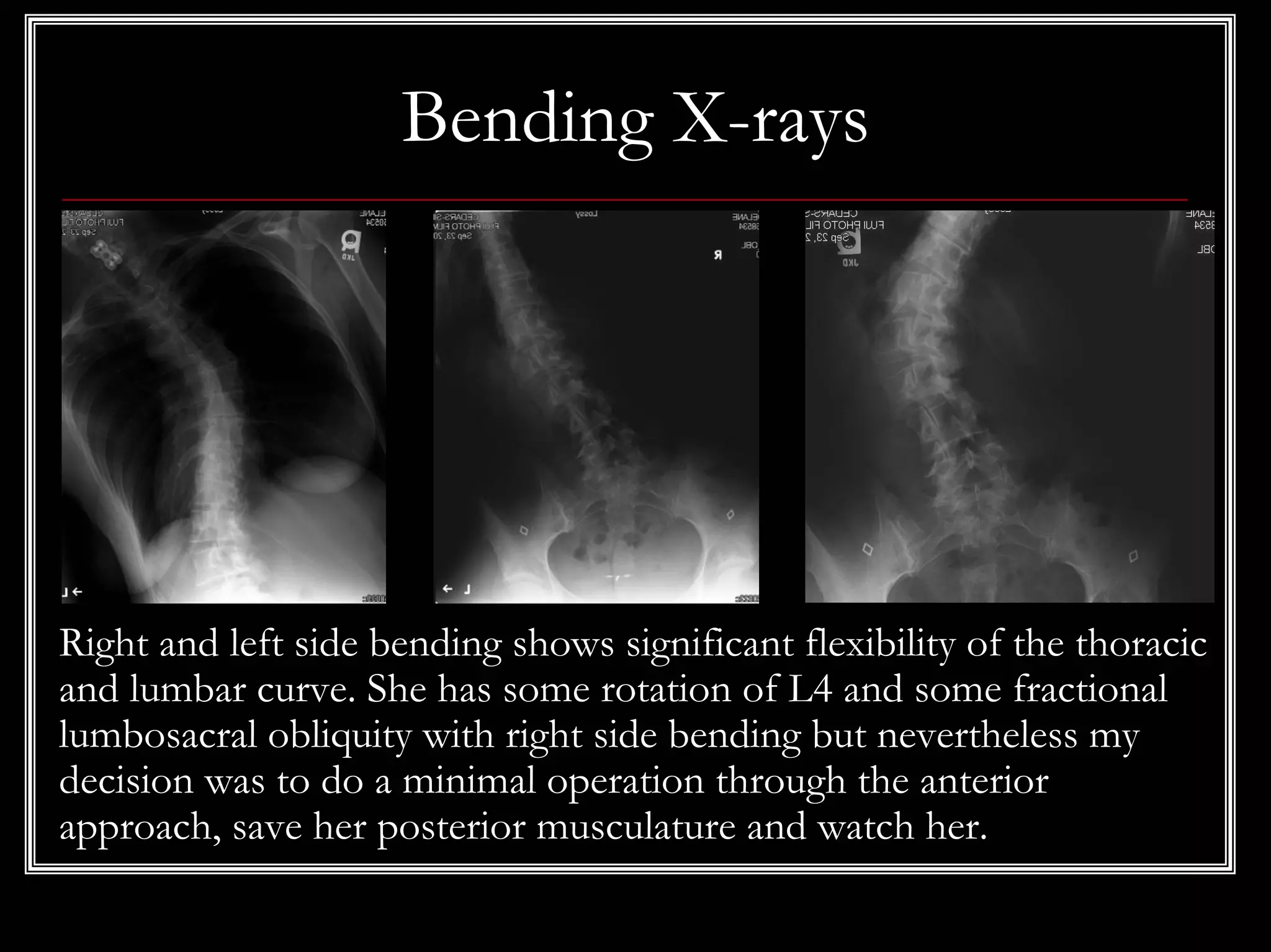 Case Review #43: 43 year old female with Adult Idiopathic Scoliosi ...