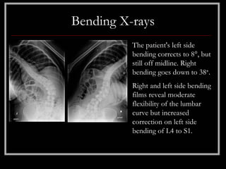 Case Review #47: 20 year old female with Adult Idiopathic Scoliosis | PPT