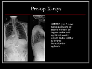 Case Review #51: 59 year old Female with Collapsing Scoliosis | PDF ...