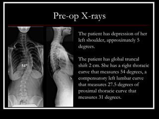Case Review #22: 21 year old with Progressive Adolescent Idiopathic ...