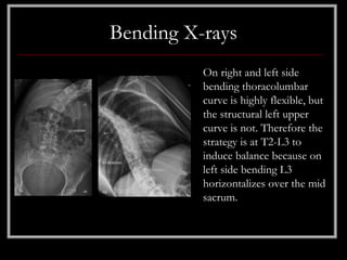 Case Presentation#56: Adult Idiopathic Scoliosis | PDF