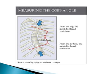 Scoliosis and cobb angle | PPTX