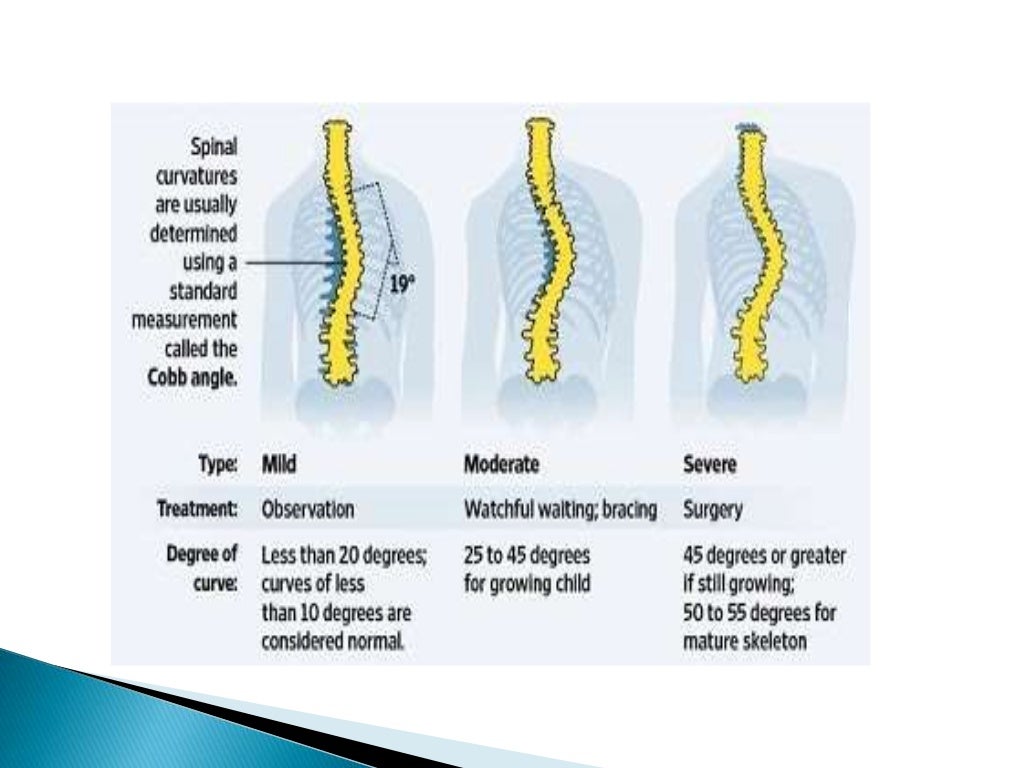 Scoliosis and cobb angle