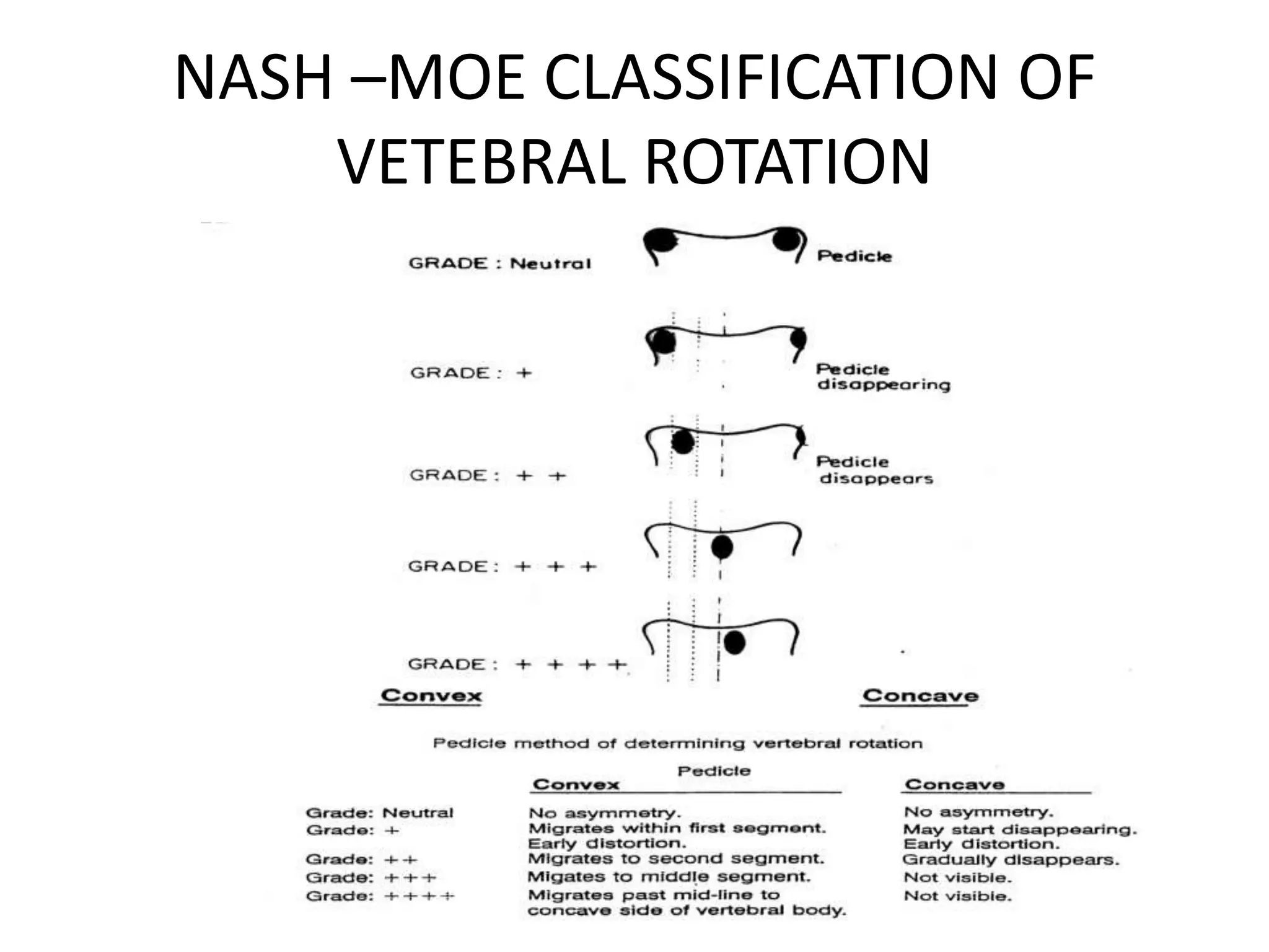 Scoliosis and effectiveness of bracing | PPTX
