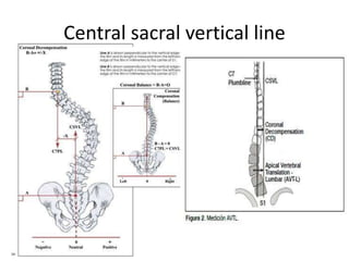 Scoliosis and effectiveness of bracing | PPTX