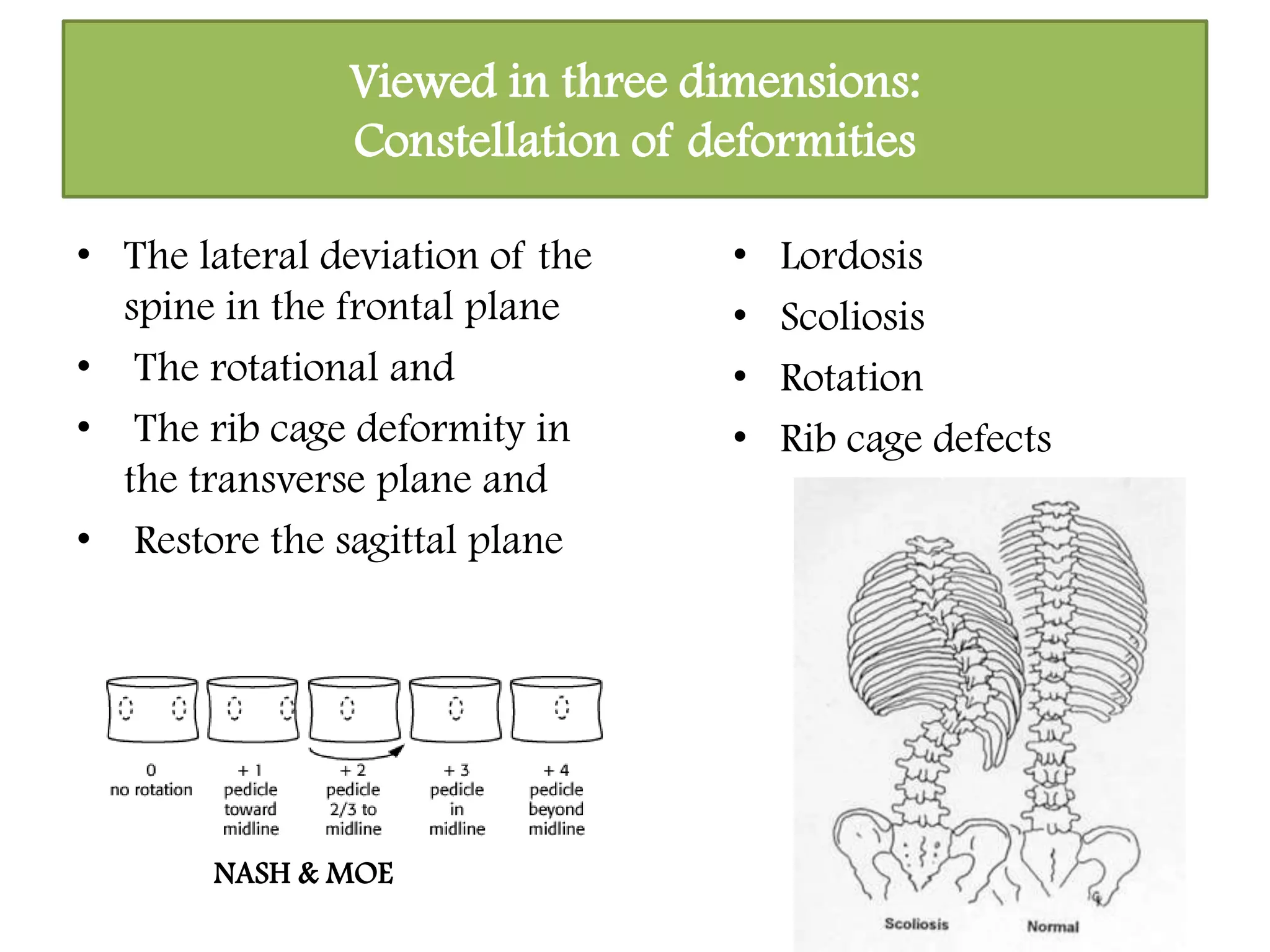 Scoliosis bracing | PPTX