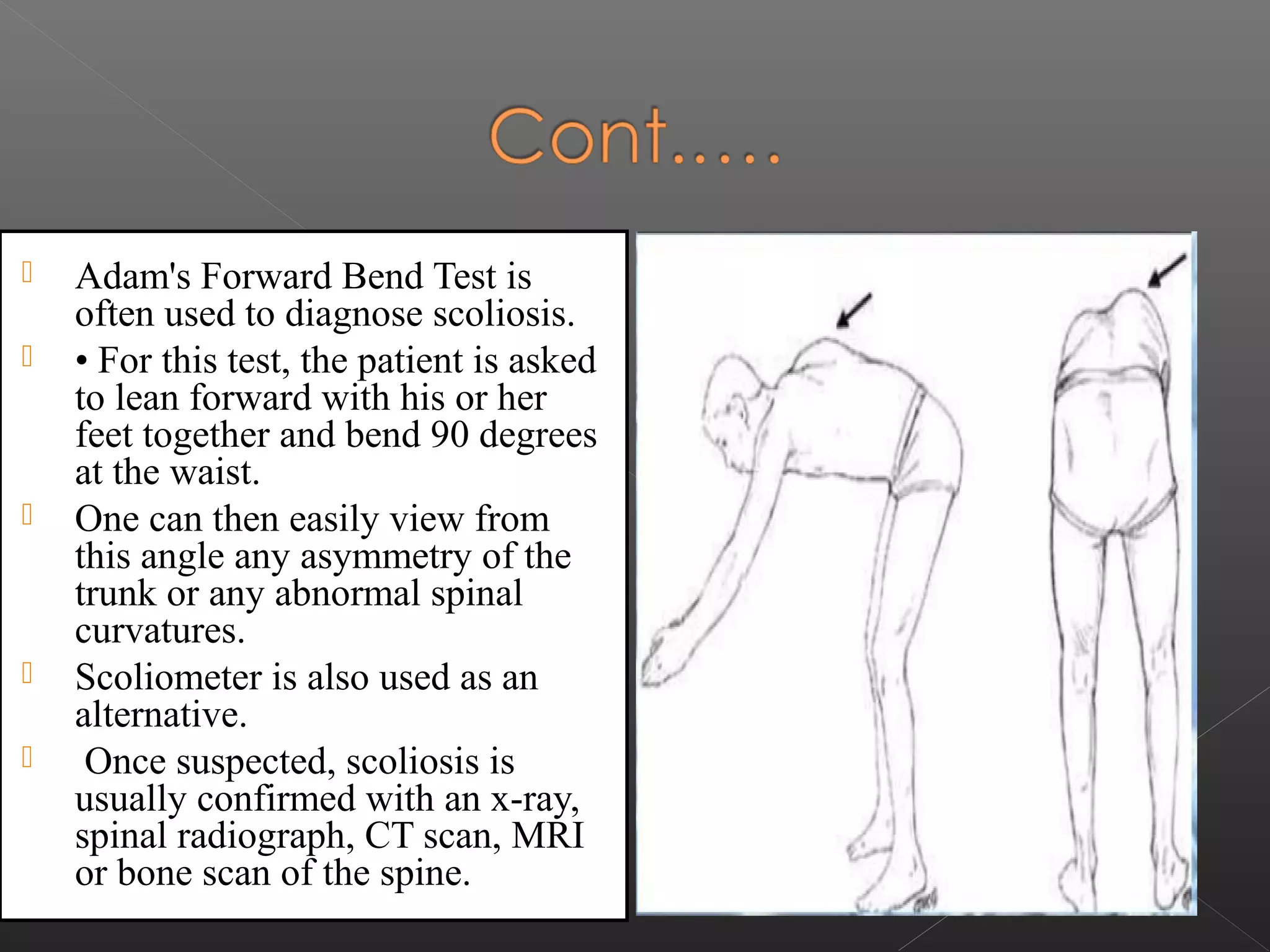 Scoliosis by aamir sharif | PPT