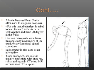 Scoliosis by aamir sharif | PPT