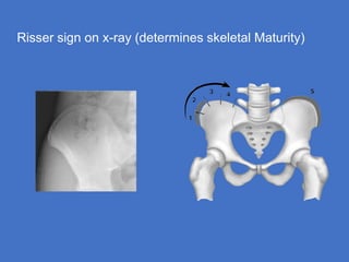 Scoliosis for Med students AYMAN AWLIA 2023.pdf