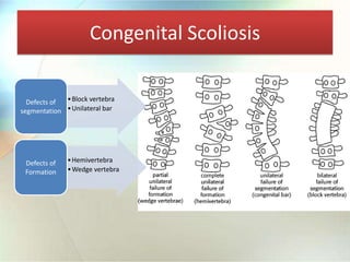 Scoliosis | PPTX