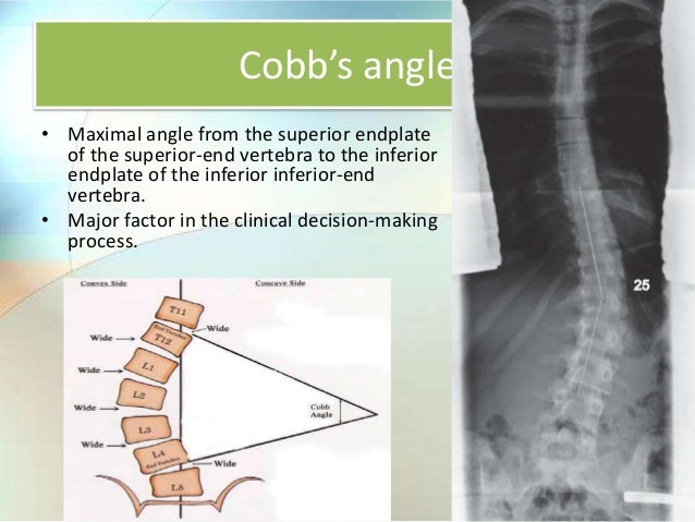 Scoliosis