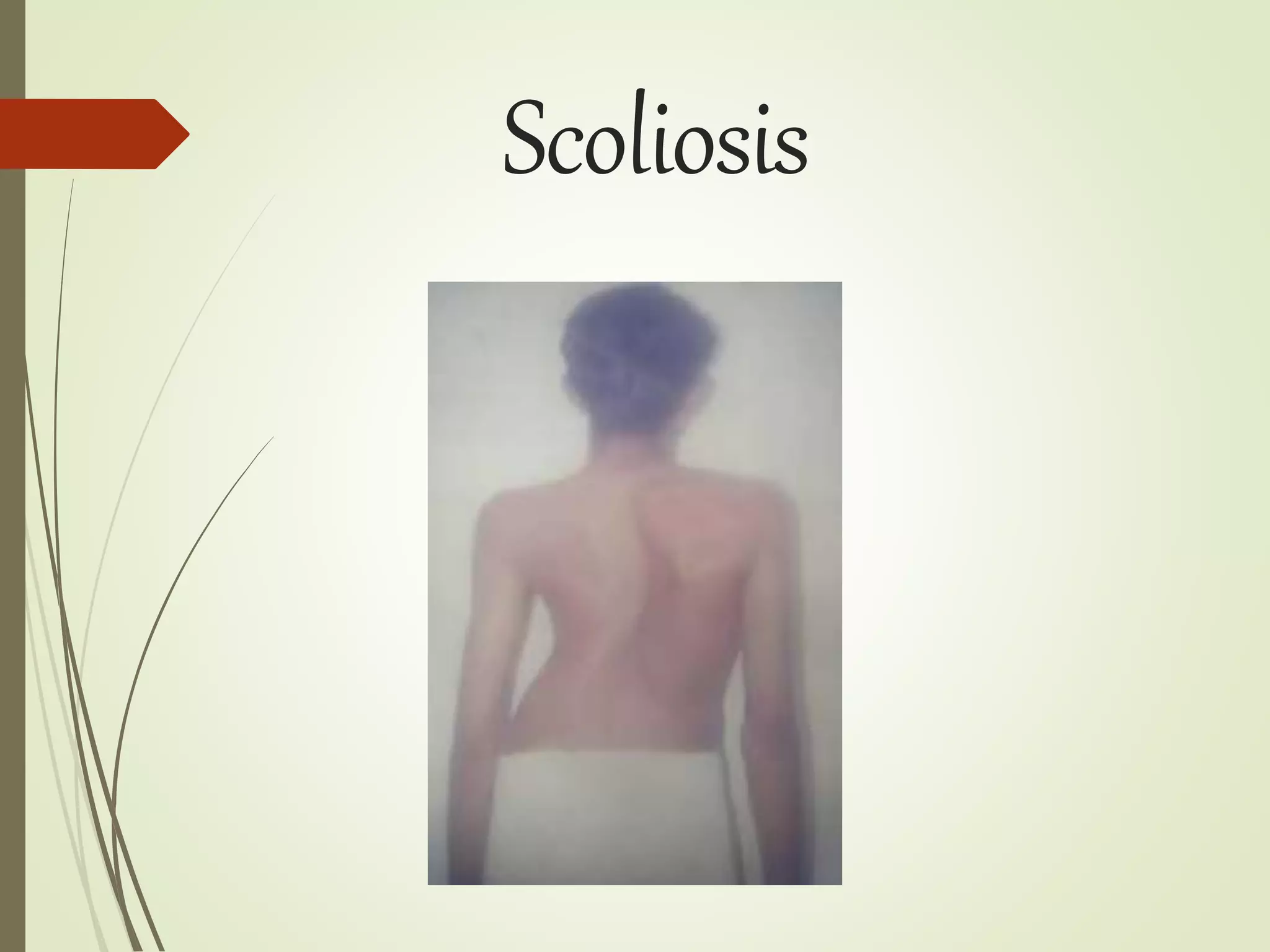 scoliosis ppt.pptx
