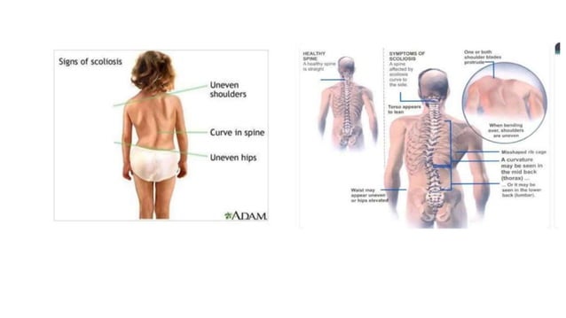 SCOLIOSIS PPT DR VASU SRIVASTAVA.pptx
