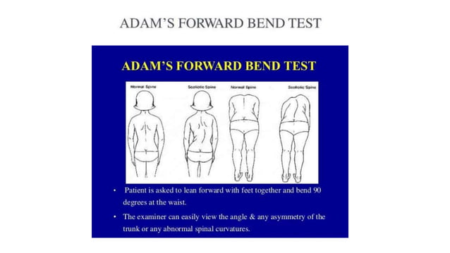 SCOLIOSIS PPT DR VASU SRIVASTAVA.pptx