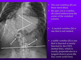 Scoliosis seminar | PPTX