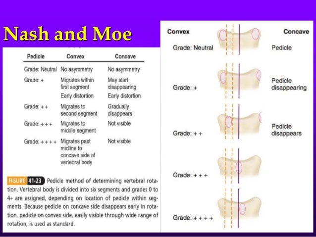 Scoliosis seminar