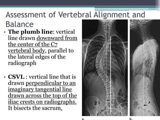 Plumb Line Scoliosis