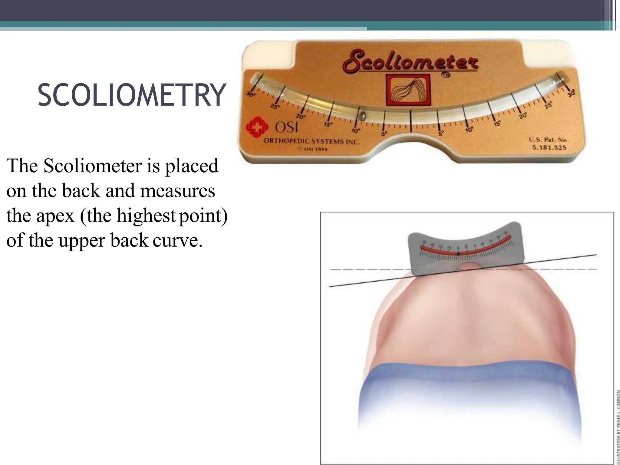 scoliosisseminarfinal-190115143952 (1).pptx