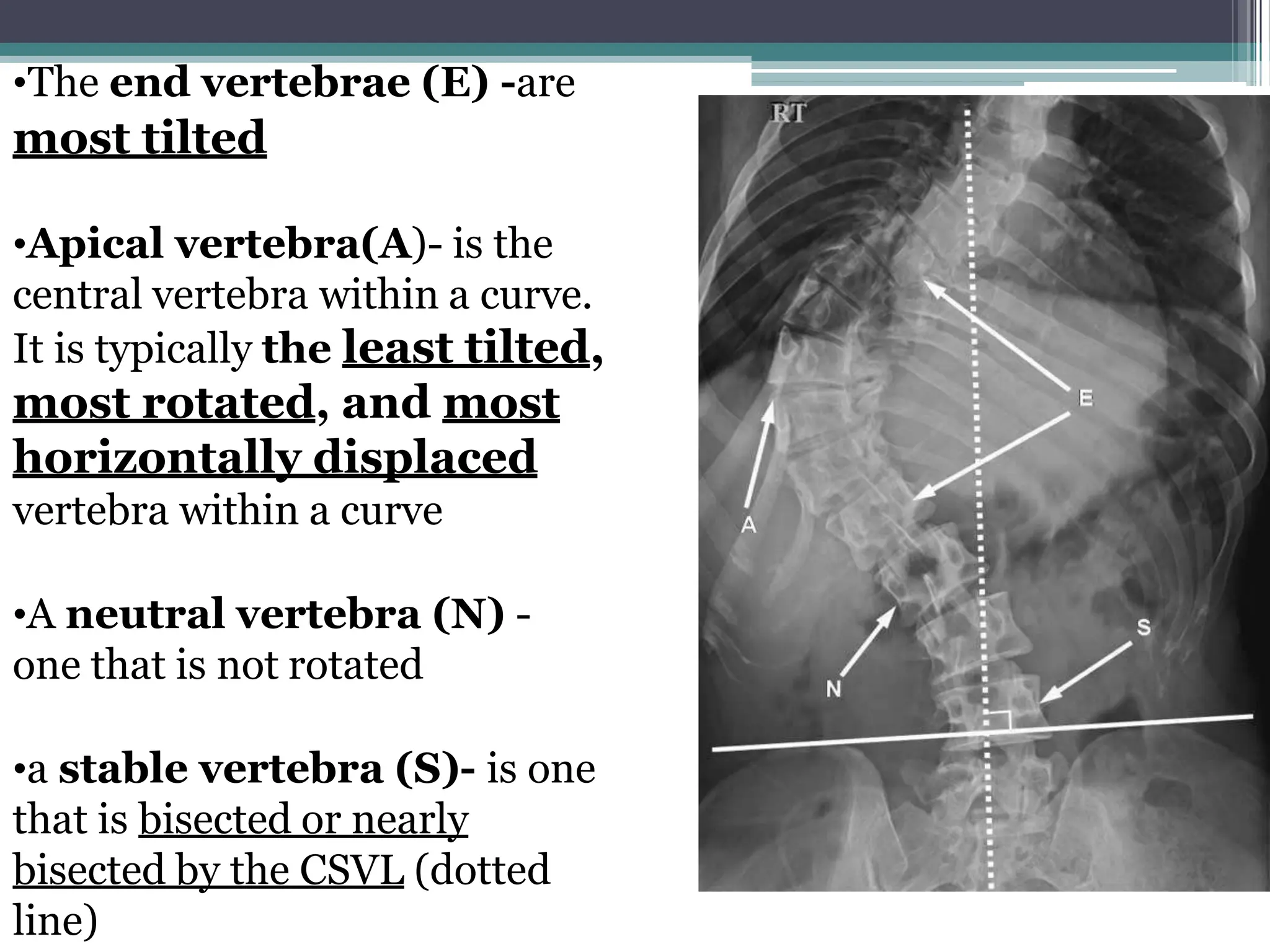 scoliosisseminarfinal-190115143952 (1).pptx