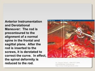 Surgery For Scoliosis | PPT