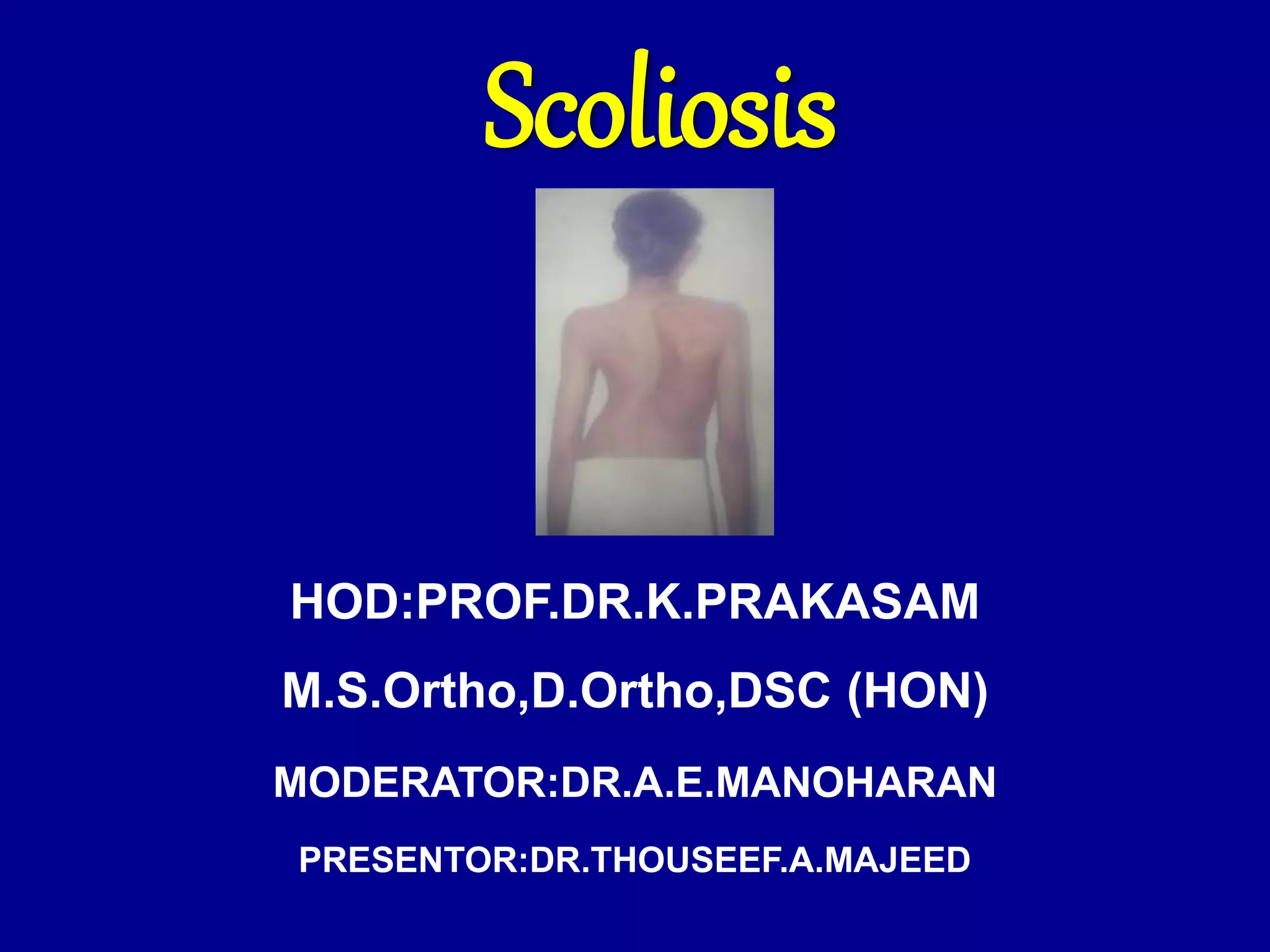 Scoliosis | PPTX