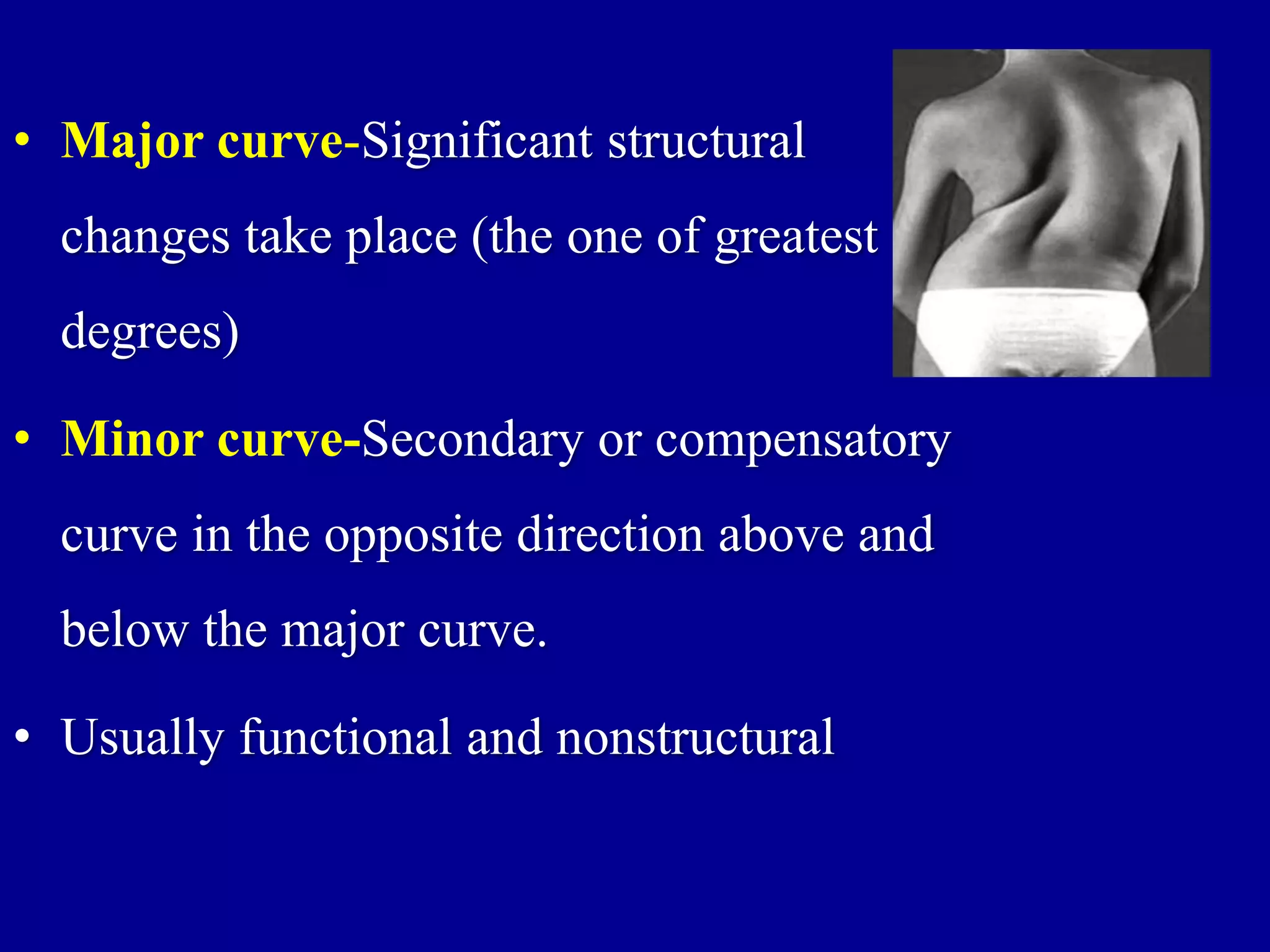 Scoliosis | PPTX