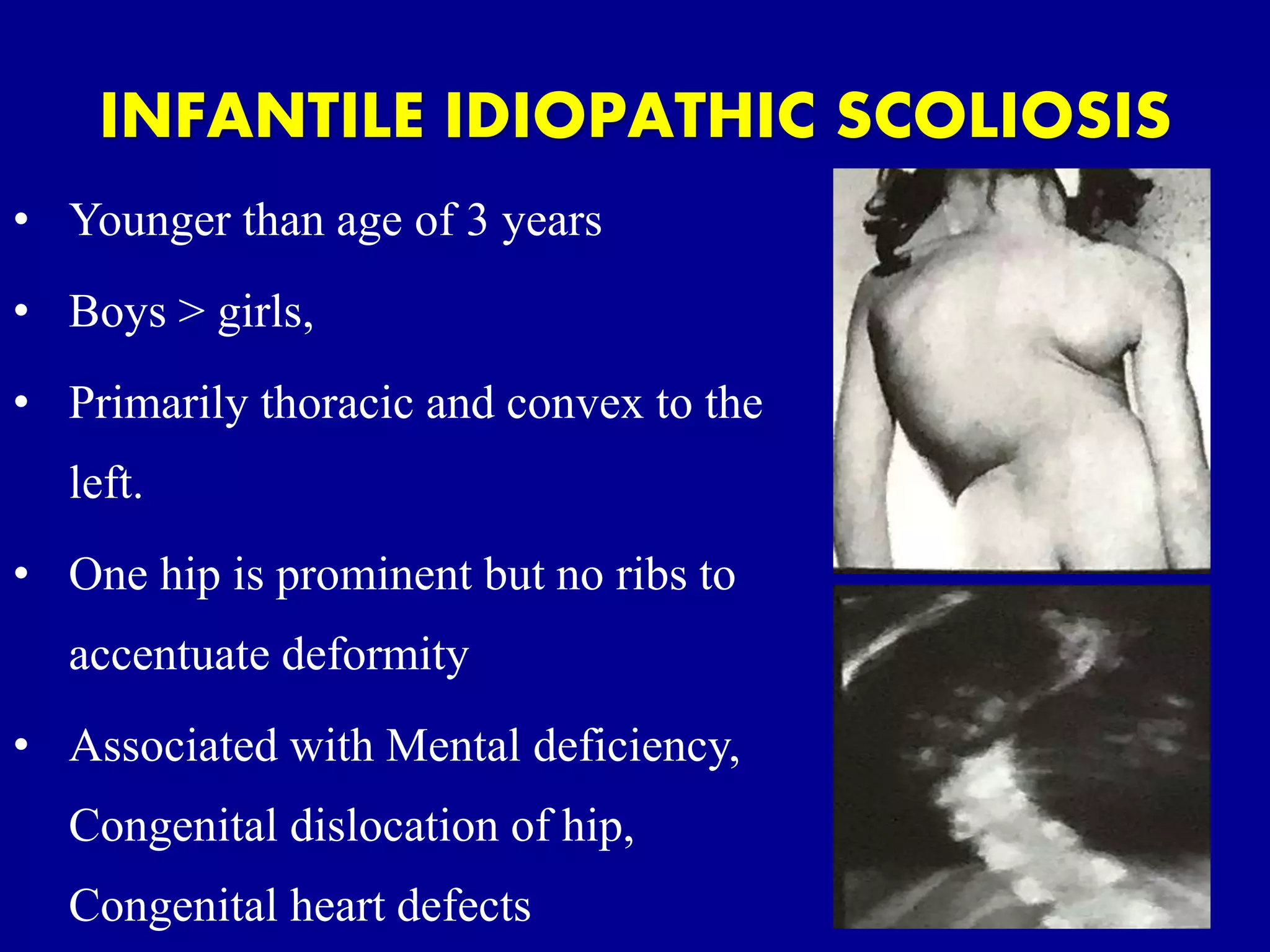 Scoliosis | PPTX